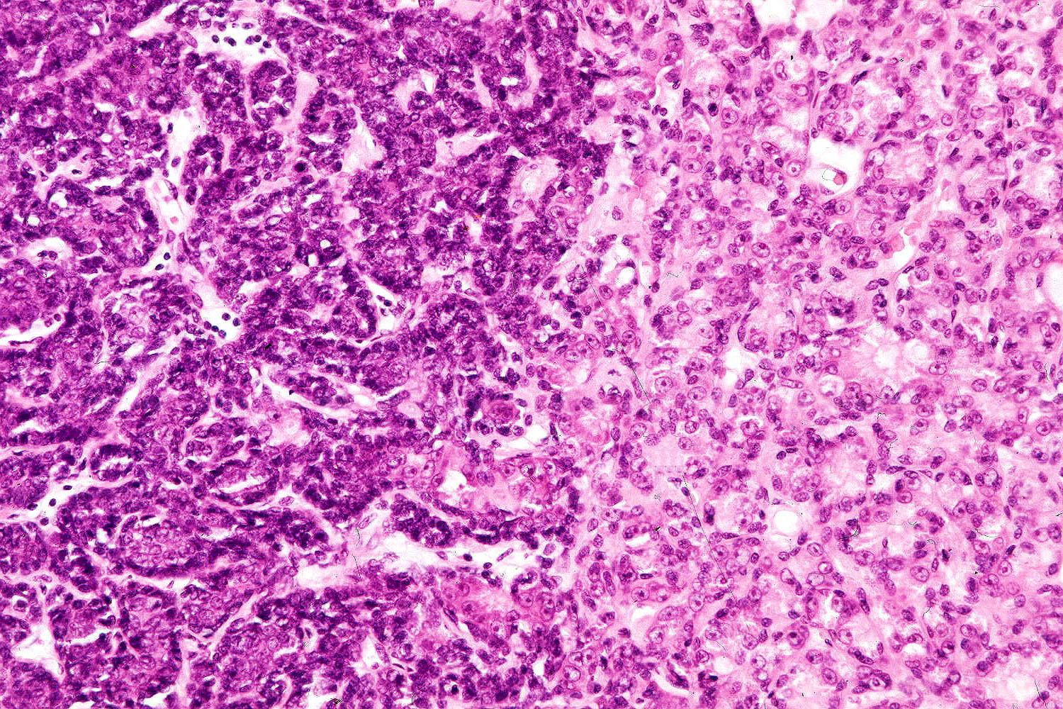 Carcinoma ex spiradenoma (eccrine spiradenocarcinoma, malignant eccrine ...