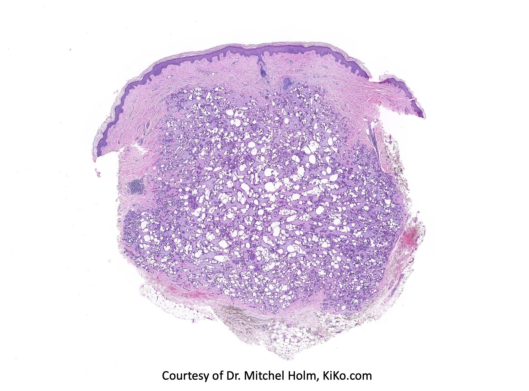 Primary cutaneous cribriform apocrine carcinoma – McKee Derm