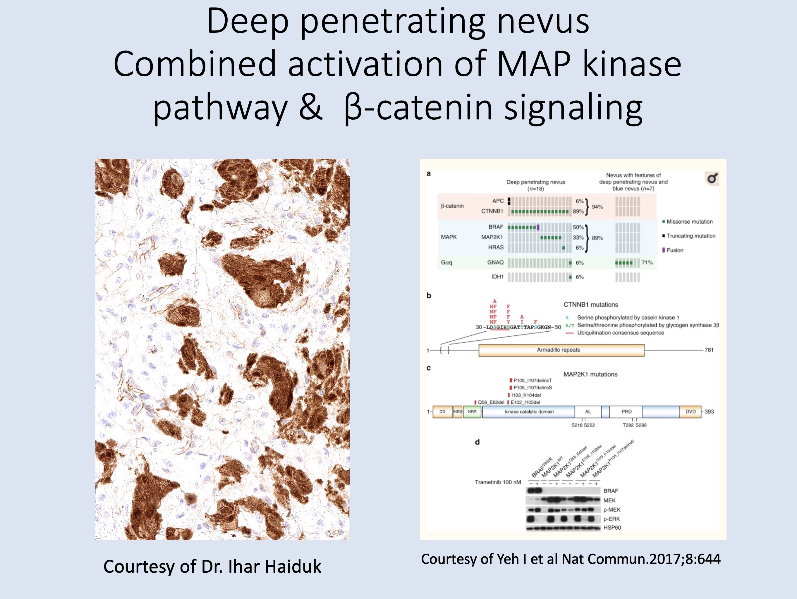 WNT activated deep penetrating/plexiform melanocytoma (deep penetrating ...