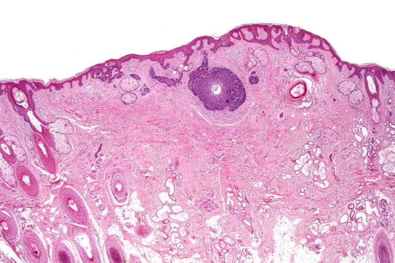 Nevus sebaceus (sebaceous nevus of Jadassohn, organoid nevus) – McKee Derm