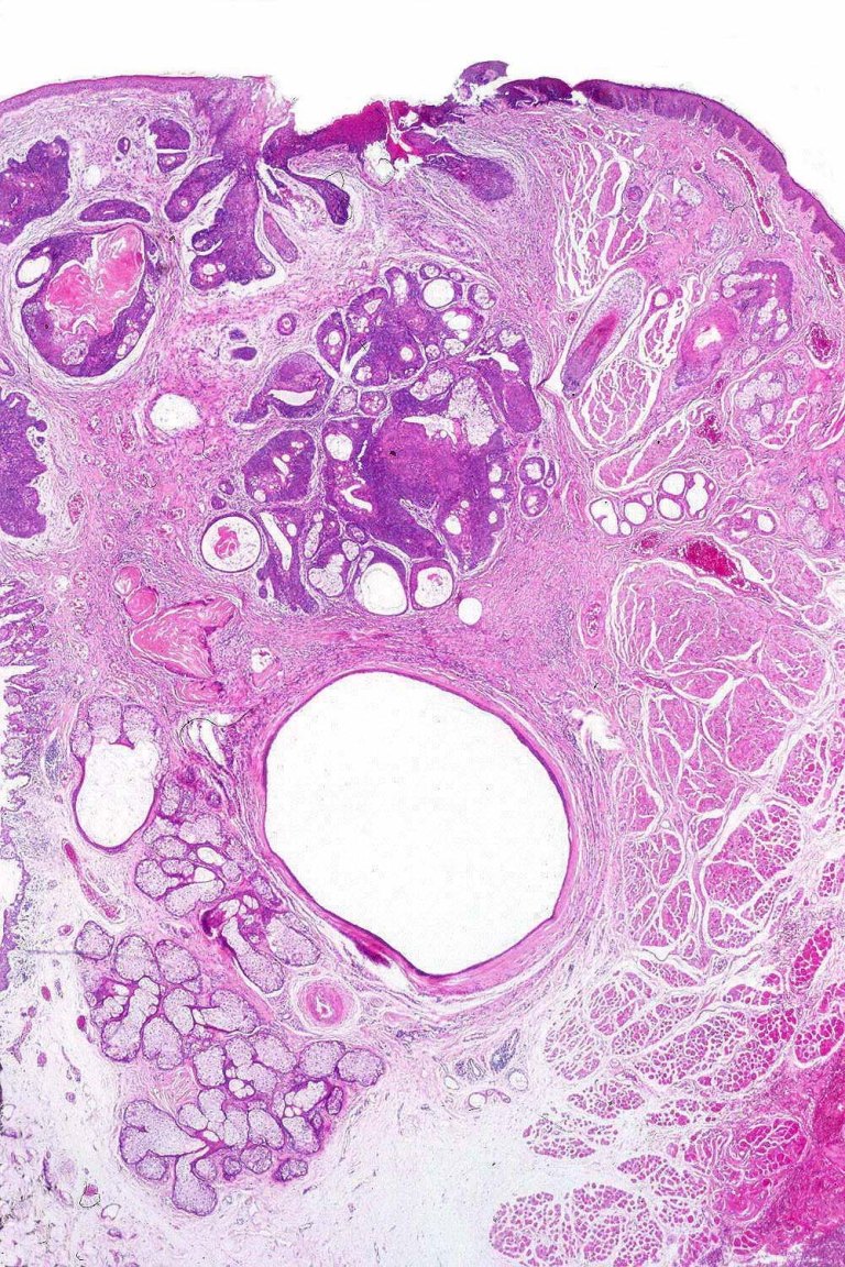 Sebaceous hyperplasia, sebaceous adenoma, sebaceoma & sebaceous ...