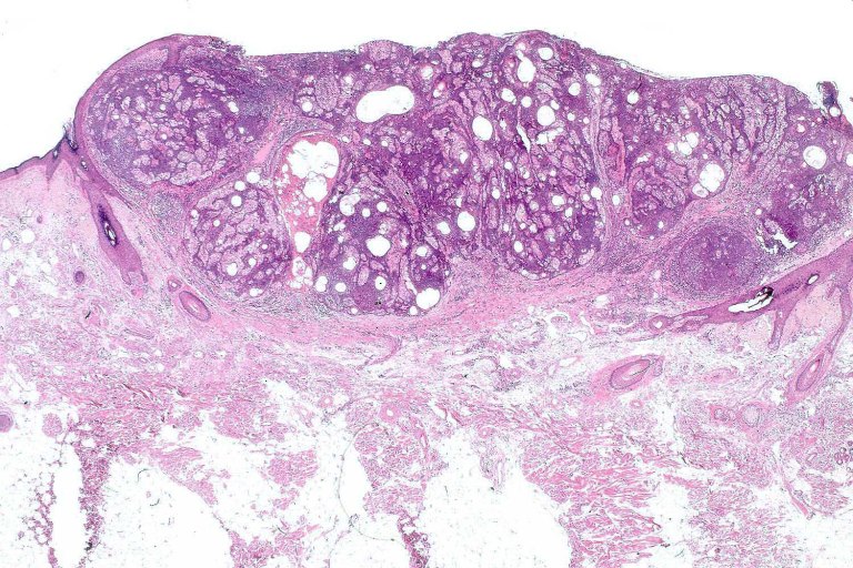 Sebaceous hyperplasia, sebaceous adenoma, sebaceoma & sebaceous ...