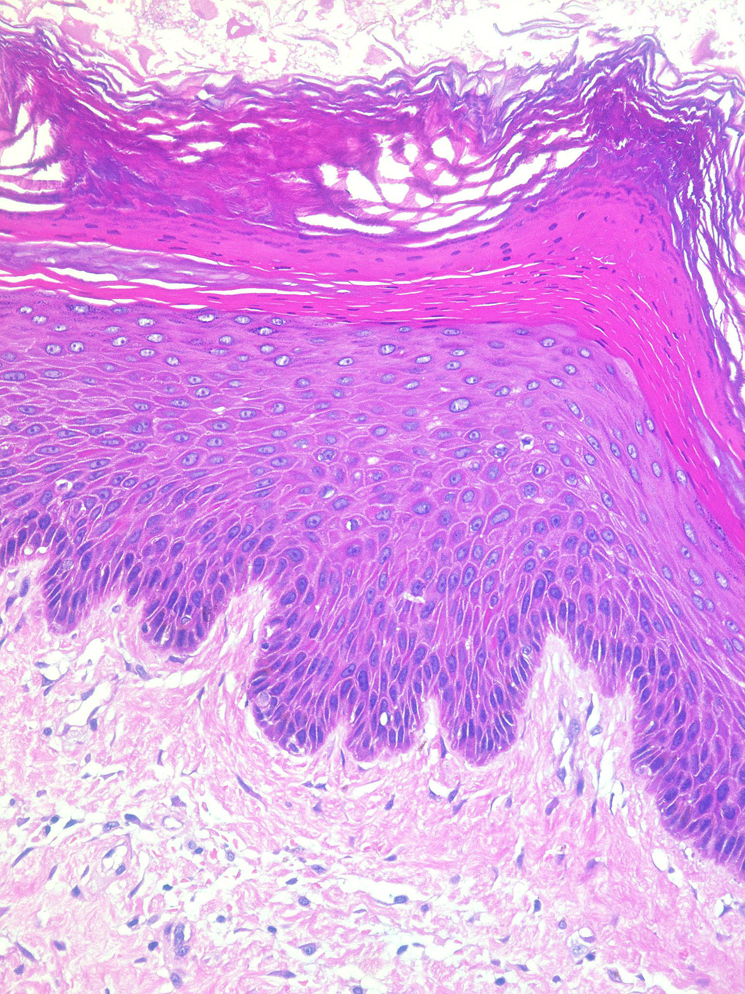 Dilated pore of Winer – McKee Derm