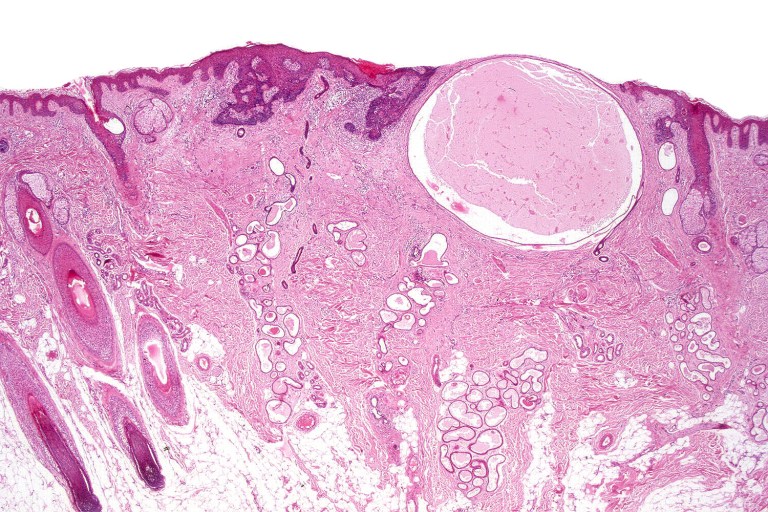 Nevus sebaceus (sebaceous nevus of Jadassohn, organoid nevus) – McKee Derm