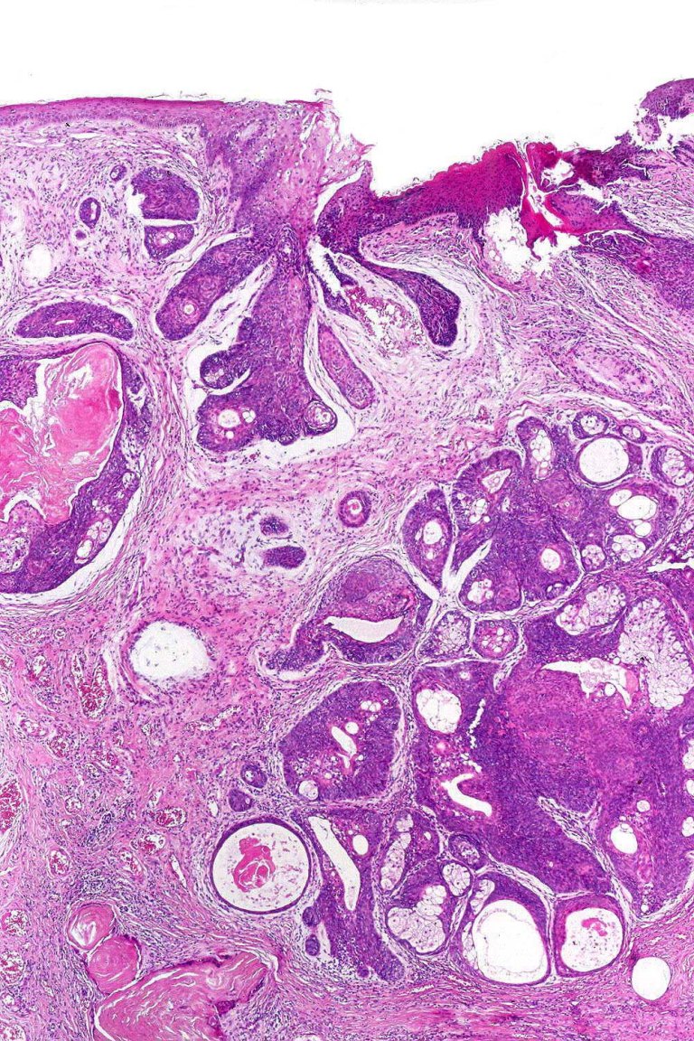 Sebaceous hyperplasia, sebaceous adenoma, sebaceoma & sebaceous ...