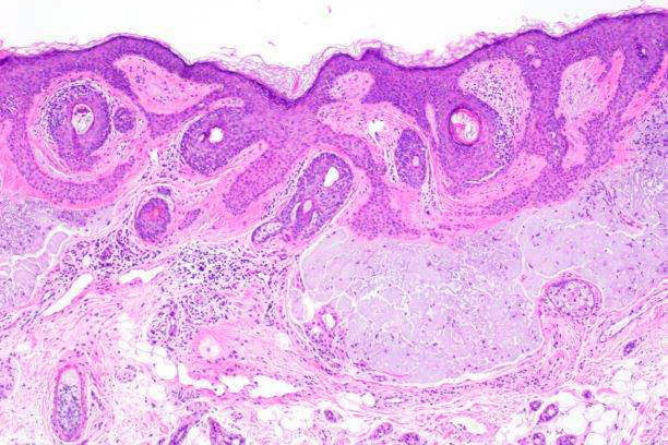 Follicular infundibulum tumor – McKee Derm
