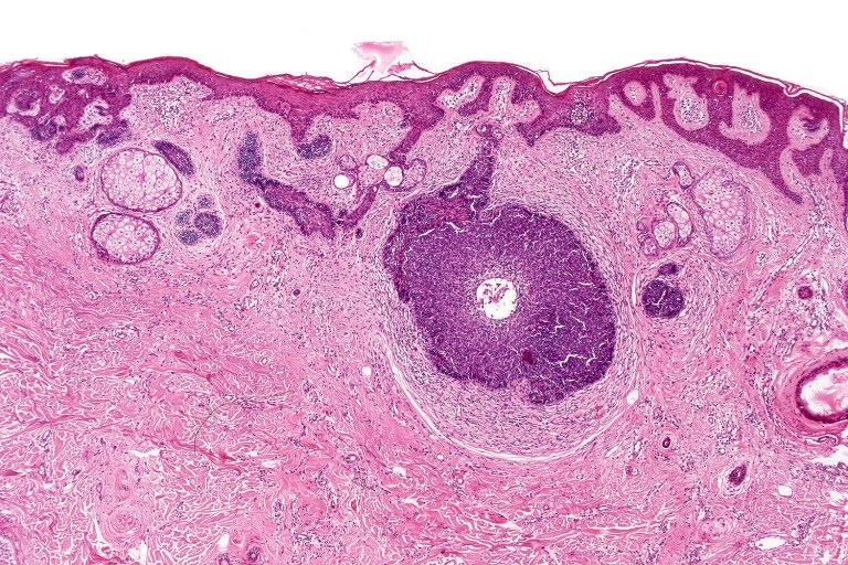 Nevus sebaceus (sebaceous nevus of Jadassohn, organoid nevus) – McKee Derm