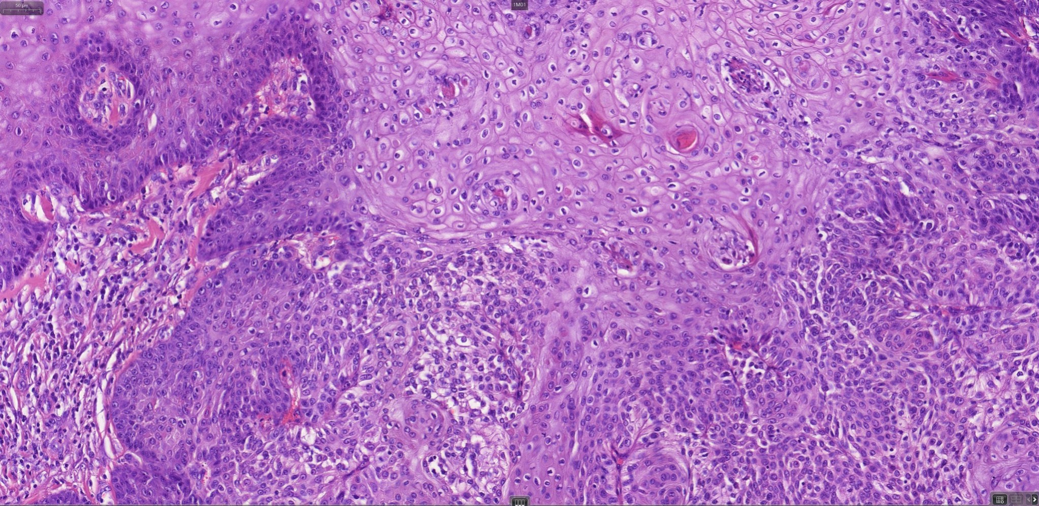 Poroma including hidroacanthoma simplex & dermal duct tumor – McKee Derm