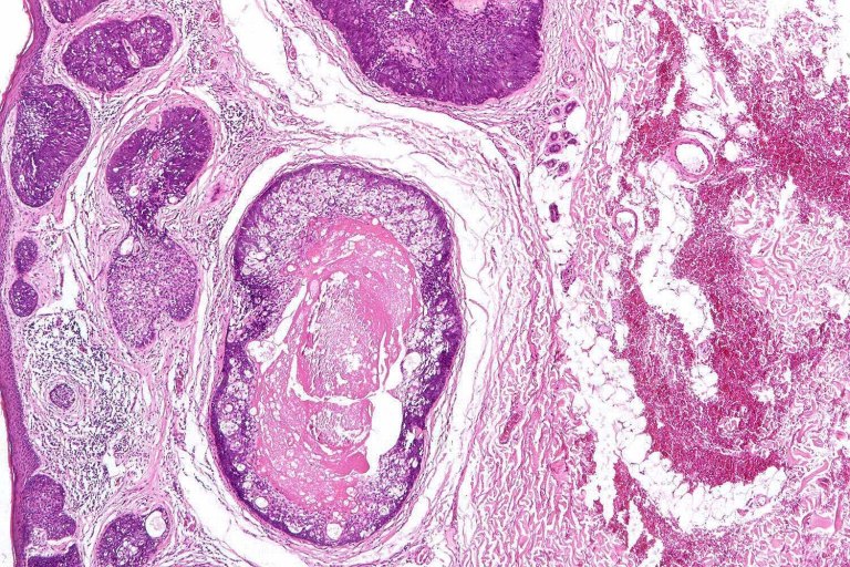 Sebaceous hyperplasia, sebaceous adenoma, sebaceoma & sebaceous ...