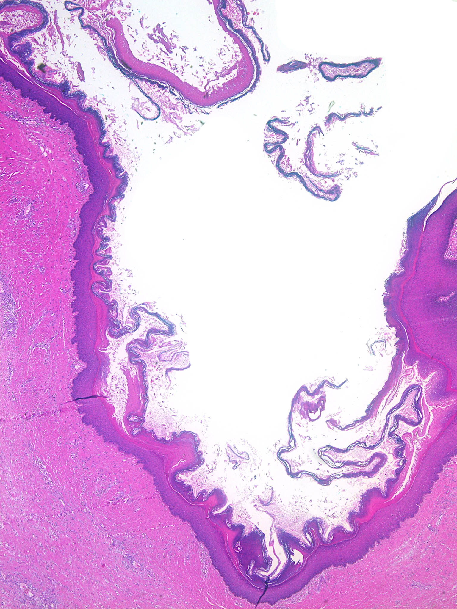 Dilated pore of Winer – McKee Derm