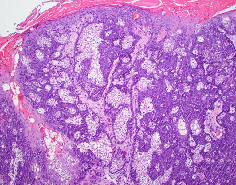 Sebaceous hyperplasia, sebaceous adenoma, sebaceoma & sebaceous ...