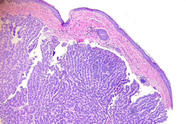 Sebaceous hyperplasia, sebaceous adenoma, sebaceoma & sebaceous ...