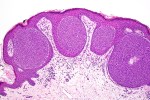 Poroma including hidroacanthoma simplex & dermal duct tumor – McKee Derm