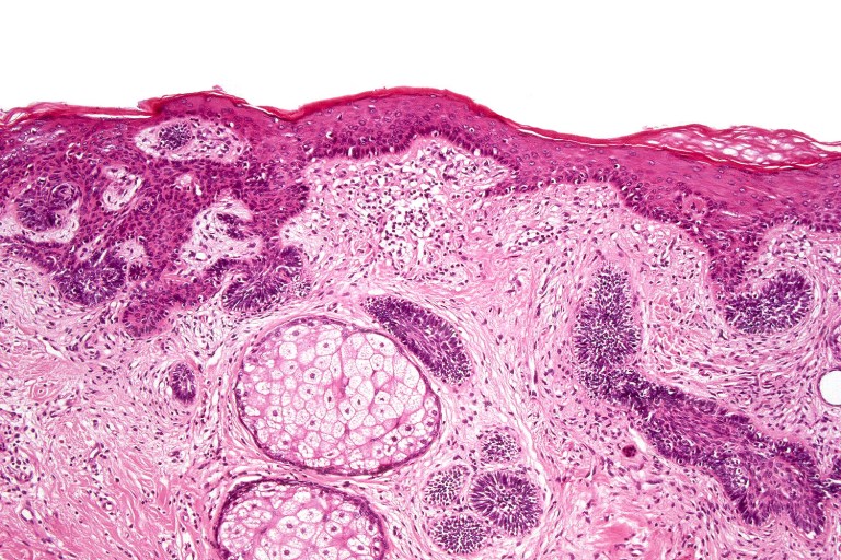 Nevus sebaceus (sebaceous nevus of Jadassohn, organoid nevus) – McKee Derm