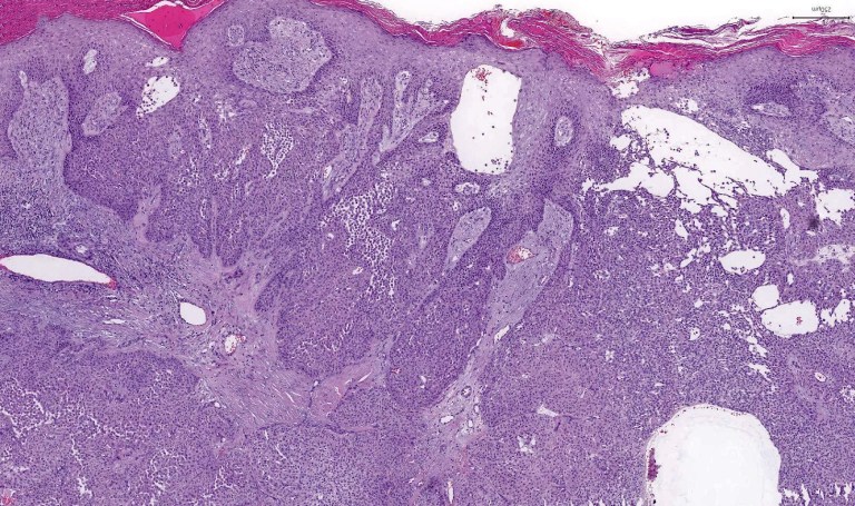 Poroma including hidroacanthoma simplex & dermal duct tumor – McKee Derm