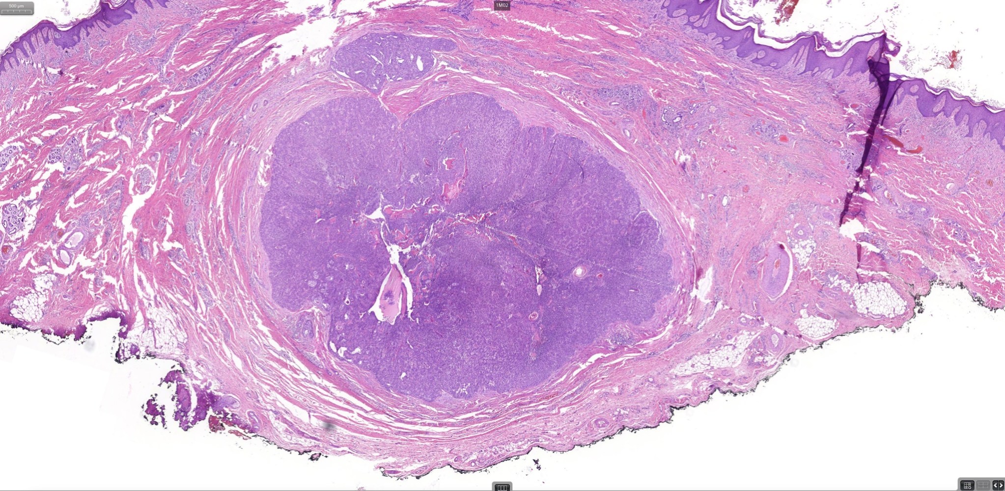 Poroma including hidroacanthoma simplex & dermal duct tumor – McKee Derm
