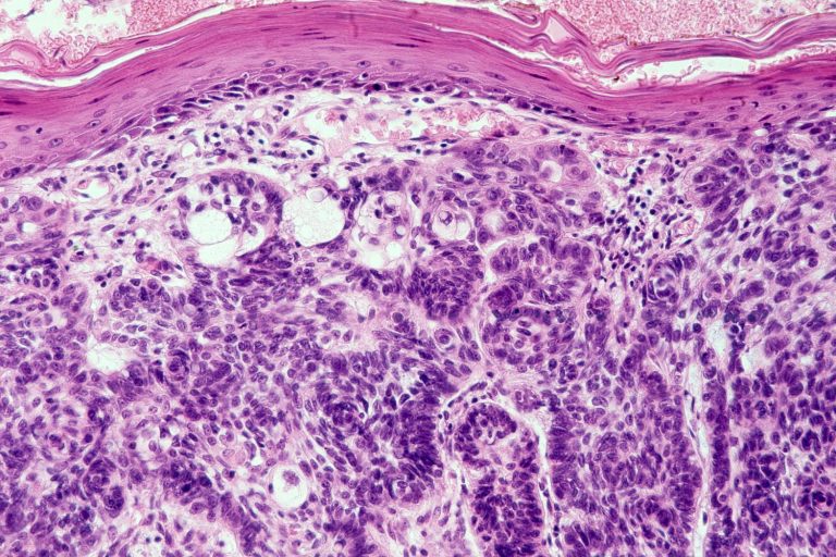 Sebaceous hyperplasia, sebaceous adenoma, sebaceoma & sebaceous ...