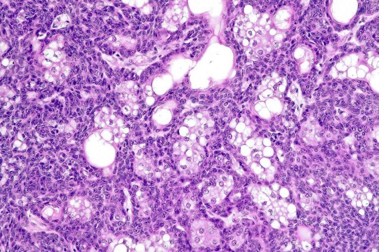 Sebaceous hyperplasia, sebaceous adenoma, sebaceoma & sebaceous ...