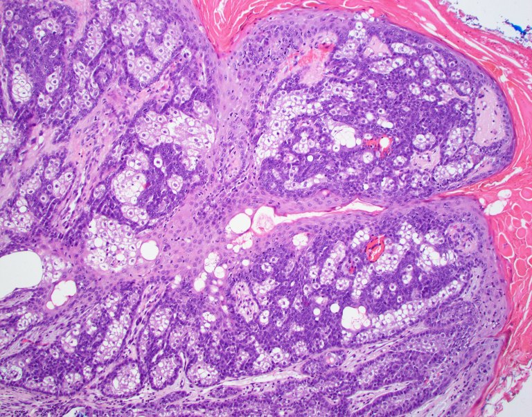 Sebaceous hyperplasia, sebaceous adenoma, sebaceoma & sebaceous ...