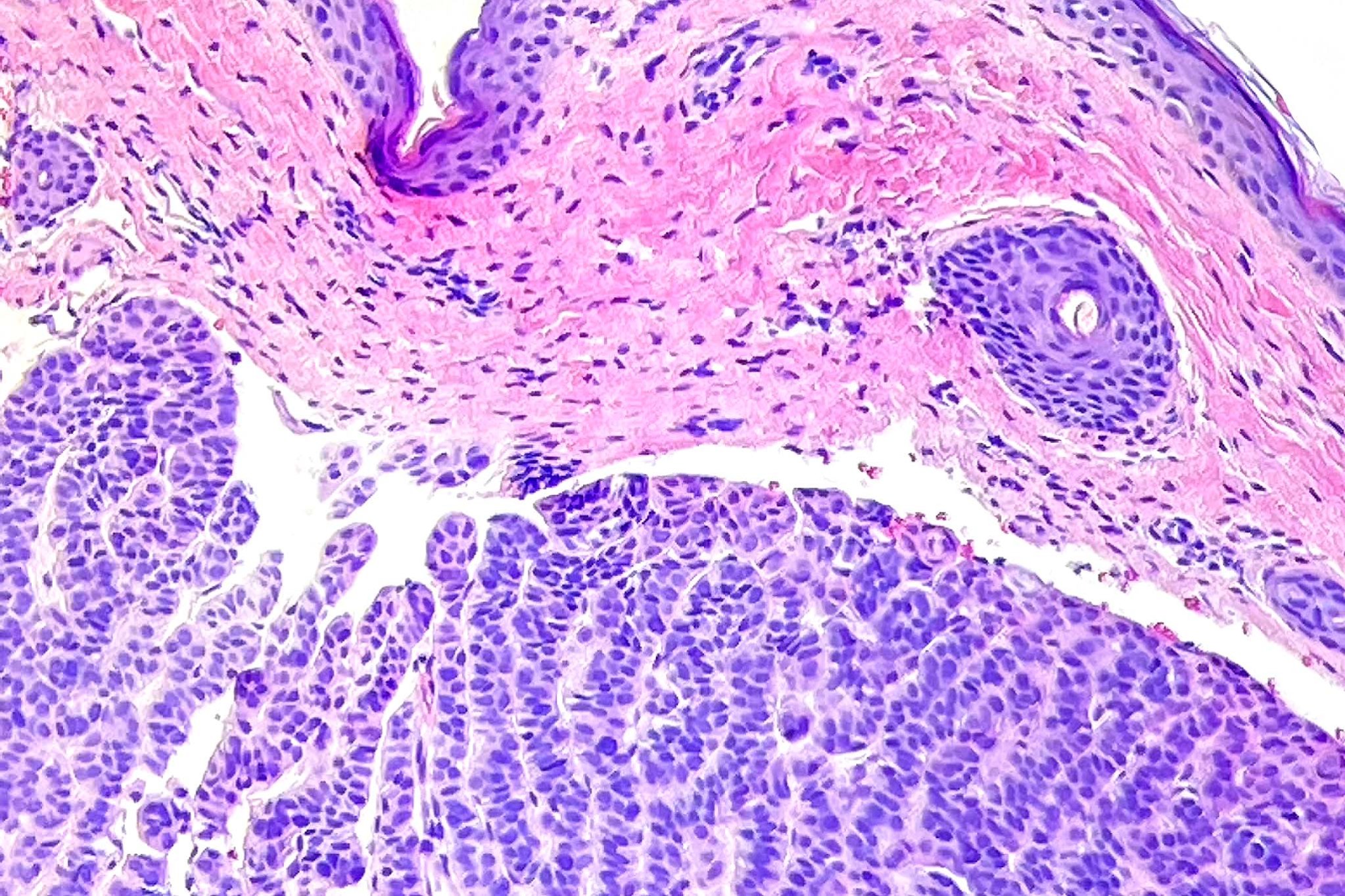 Sebaceous hyperplasia, sebaceous adenoma, sebaceoma & sebaceous ...