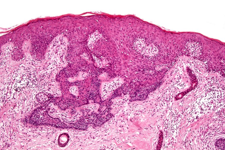 Nevus sebaceus (sebaceous nevus of Jadassohn, organoid nevus) – McKee Derm