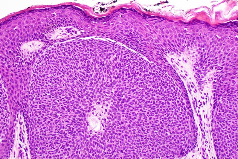 Poroma including hidroacanthoma simplex & dermal duct tumor – McKee Derm