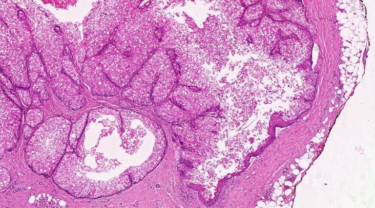 Sebaceous hyperplasia, sebaceous adenoma, sebaceoma & sebaceous ...