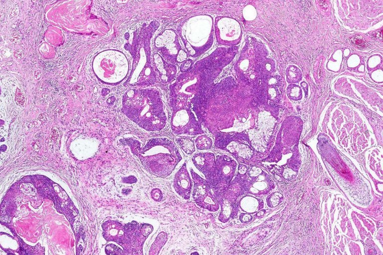 Sebaceous hyperplasia, sebaceous adenoma, sebaceoma & sebaceous ...