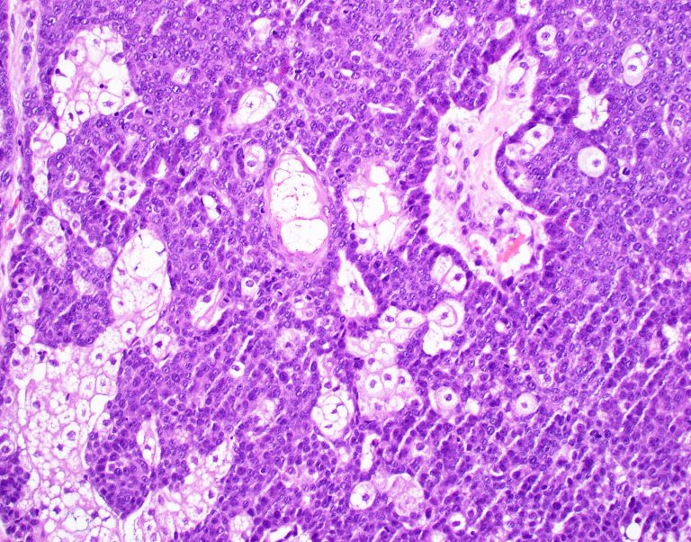 Sebaceous hyperplasia, sebaceous adenoma, sebaceoma & sebaceous ...