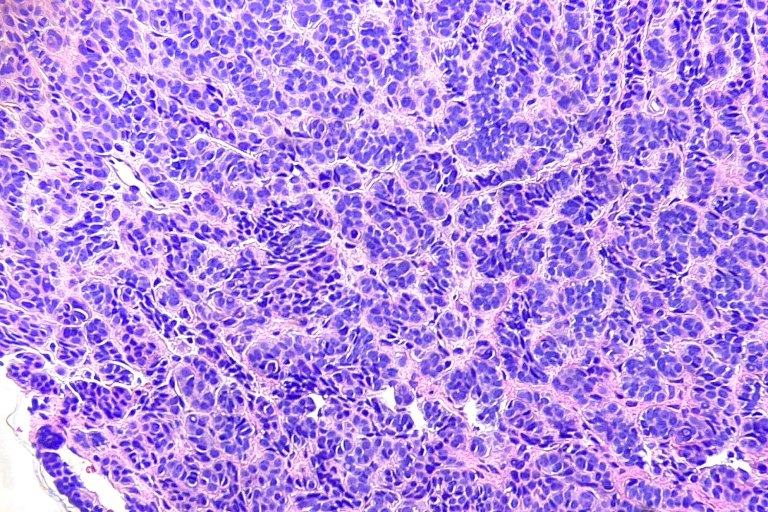 Sebaceous hyperplasia, sebaceous adenoma, sebaceoma & sebaceous ...