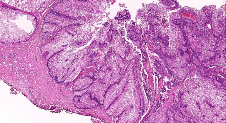 Sebaceous hyperplasia, sebaceous adenoma, sebaceoma & sebaceous ...