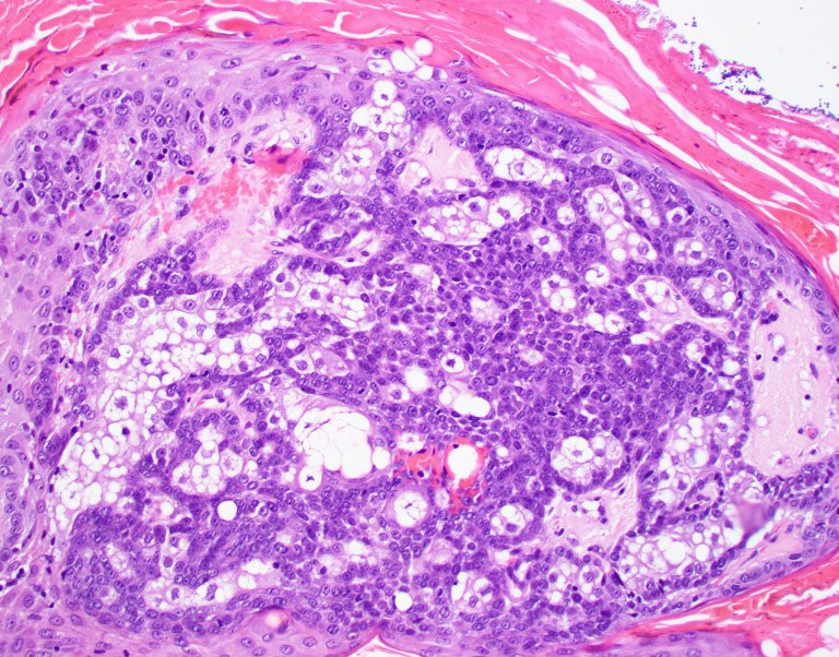 Sebaceous hyperplasia, sebaceous adenoma, sebaceoma & sebaceous ...