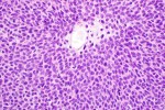 Poroma including hidroacanthoma simplex & dermal duct tumor – McKee Derm