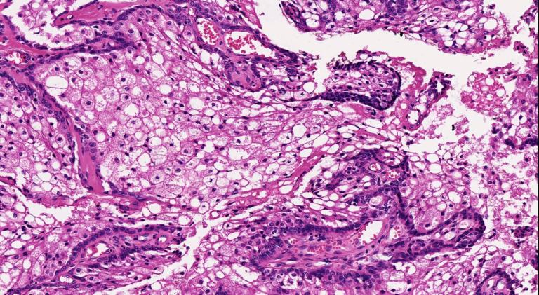 Sebaceous hyperplasia, sebaceous adenoma, sebaceoma & sebaceous ...