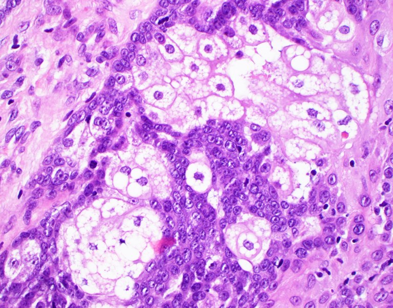 Sebaceous hyperplasia, sebaceous adenoma, sebaceoma & sebaceous ...