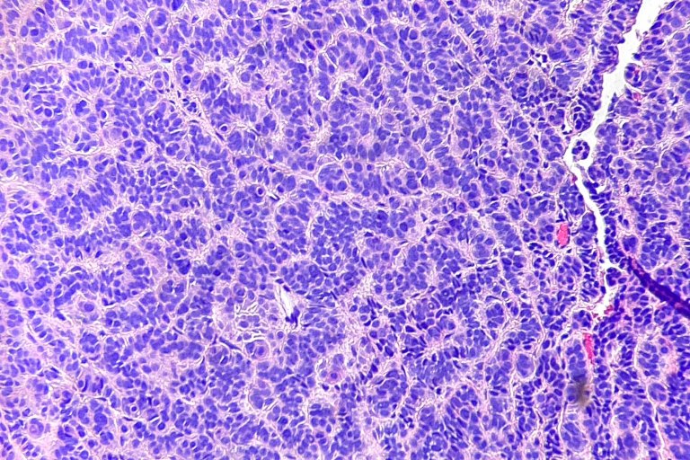 Sebaceous hyperplasia, sebaceous adenoma, sebaceoma & sebaceous ...