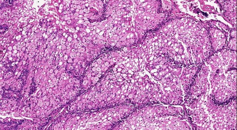 Sebaceous hyperplasia, sebaceous adenoma, sebaceoma & sebaceous ...