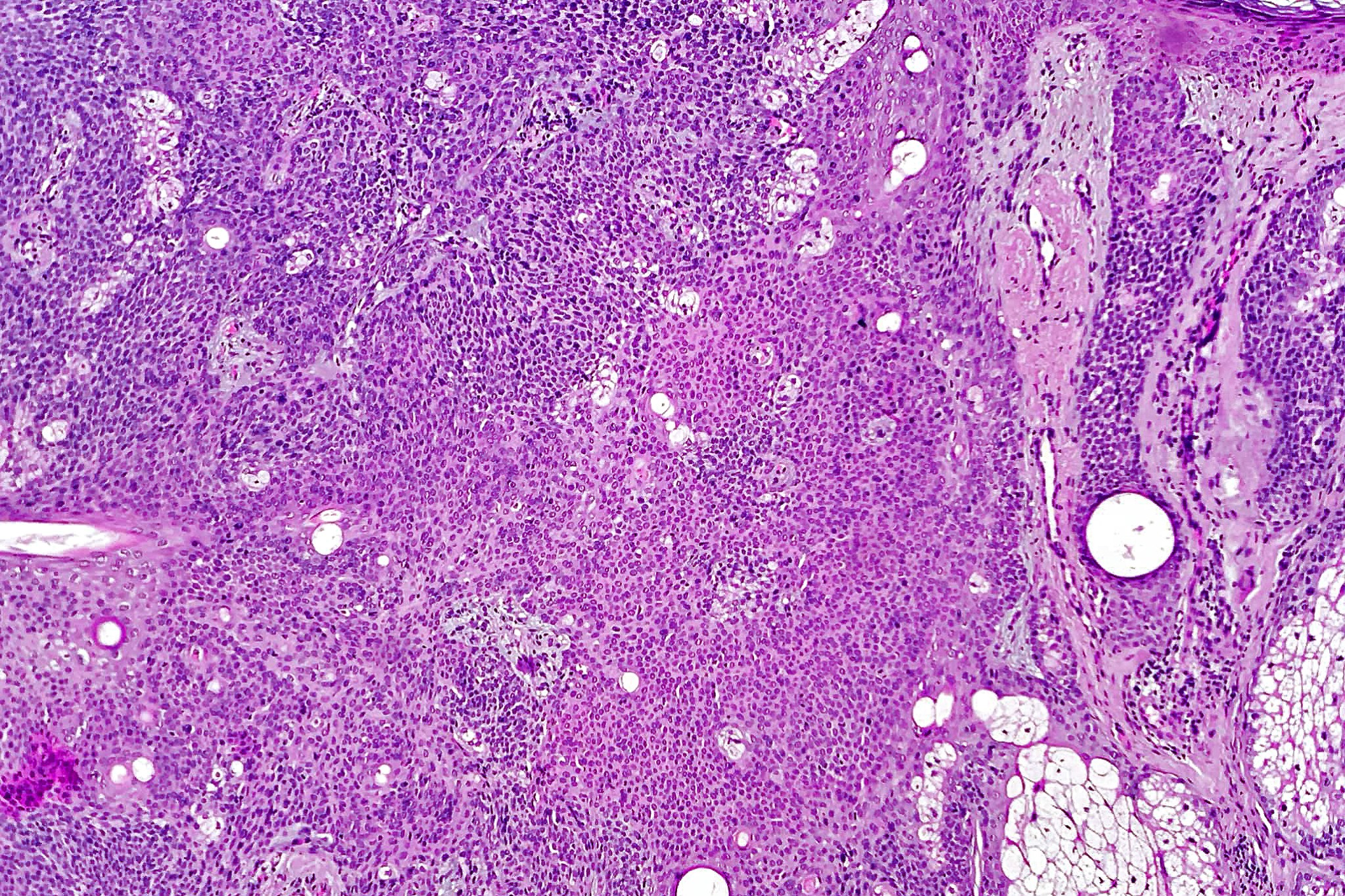 Poroma including hidroacanthoma simplex & dermal duct tumor – McKee Derm