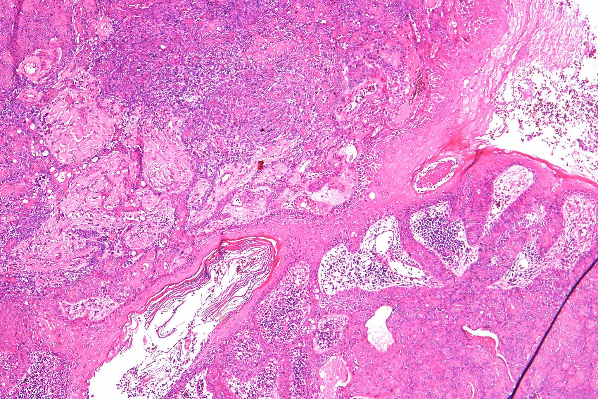Poroma including hidroacanthoma simplex & dermal duct tumor – McKee Derm