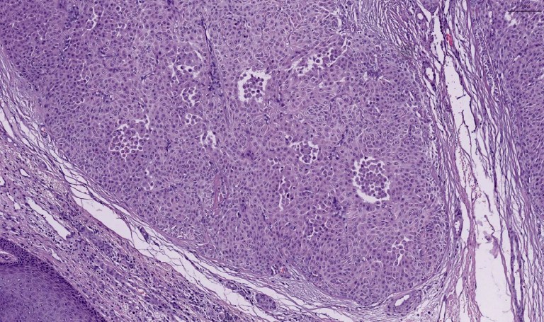 Poroma including hidroacanthoma simplex & dermal duct tumor – McKee Derm