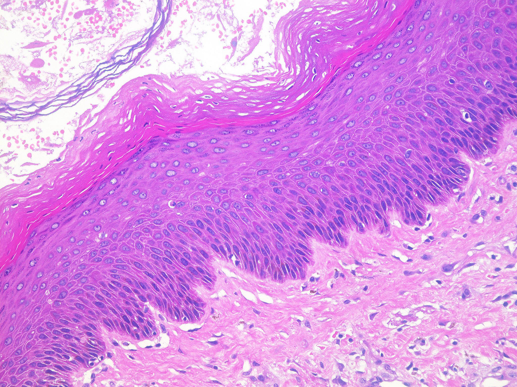 Dilated pore of Winer – McKee Derm