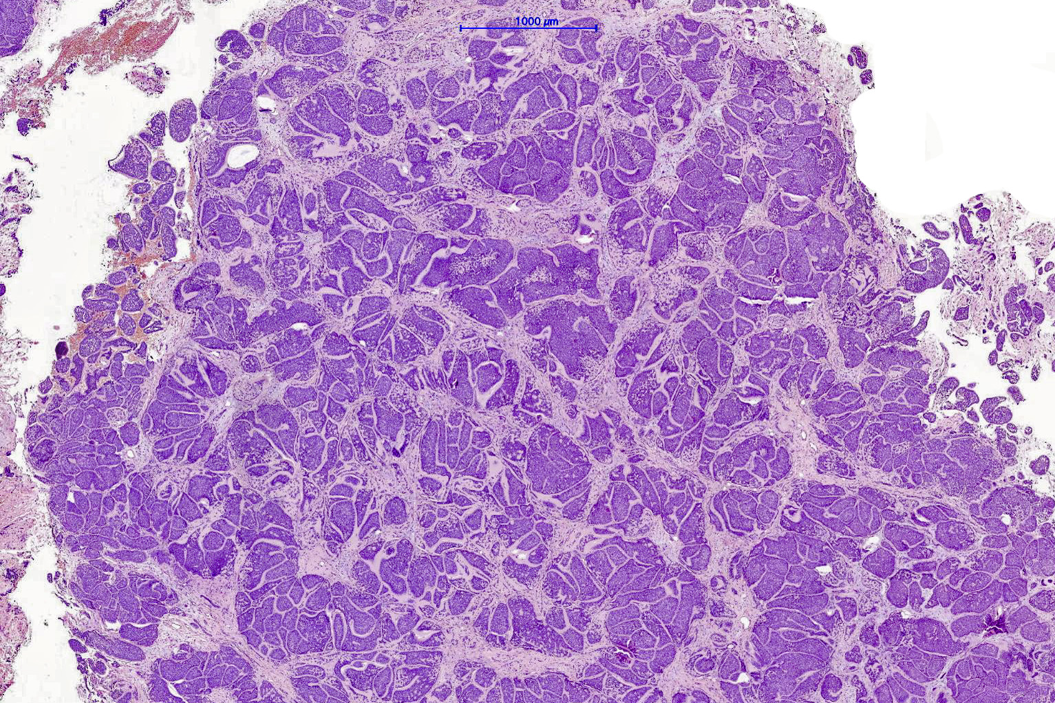 Cylindroma – McKee Derm
