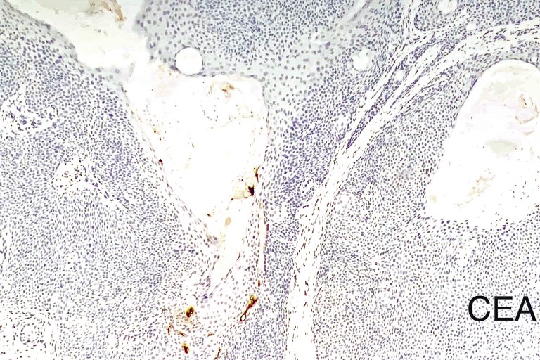 Poroma including hidroacanthoma simplex & dermal duct tumor – McKee Derm
