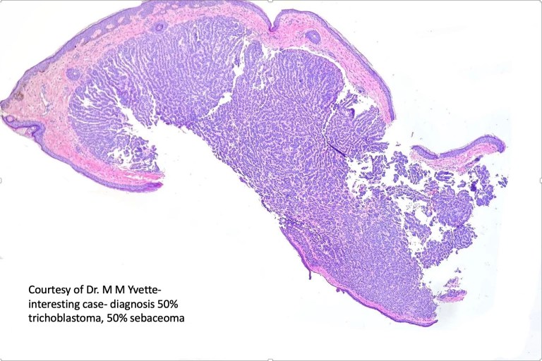 Sebaceous hyperplasia, sebaceous adenoma, sebaceoma & sebaceous ...