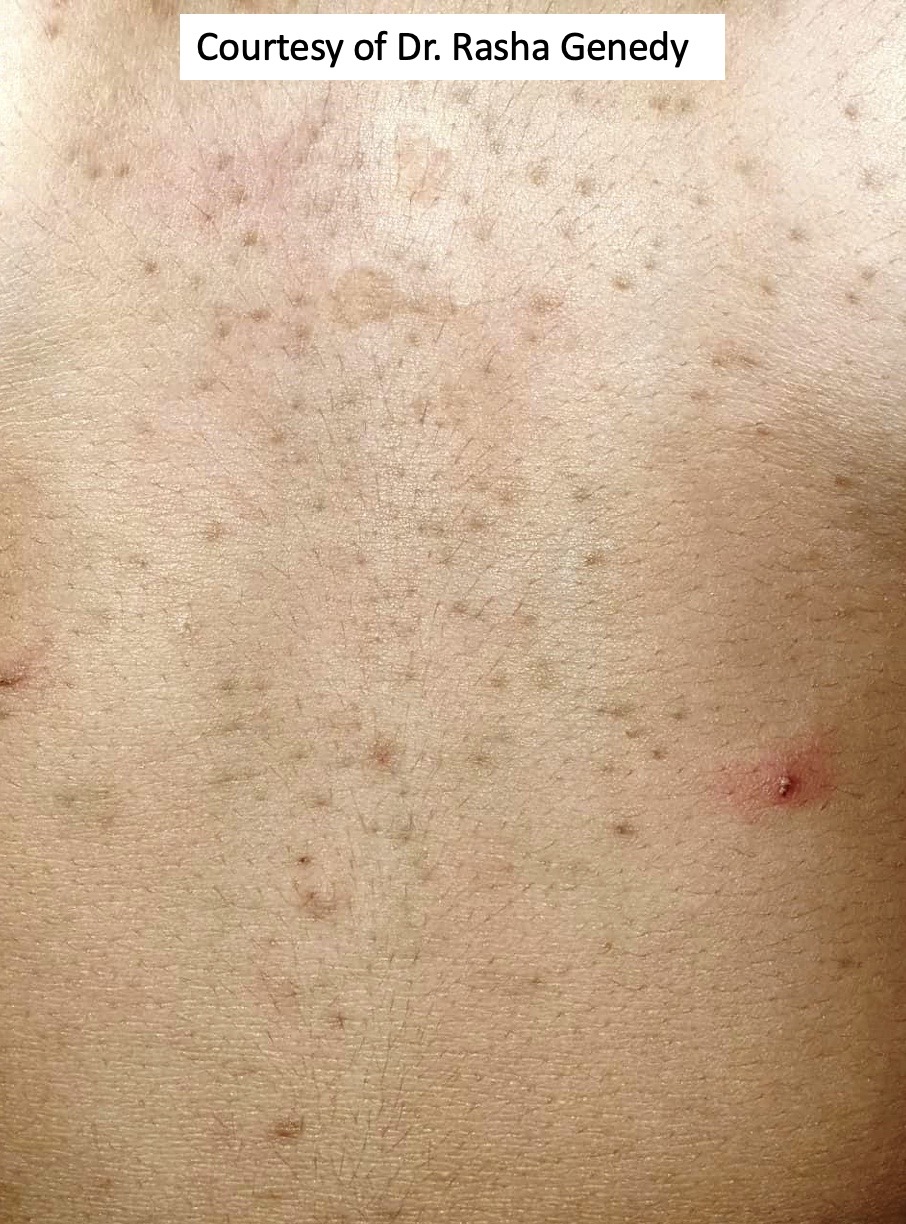 Eruptive & solitary vellus hair cyst – McKee Derm