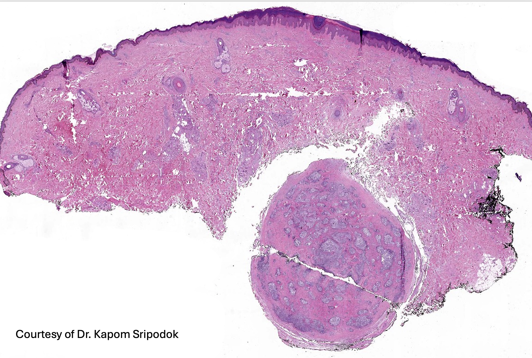 Cutaneous lymphadenoma – McKee Derm