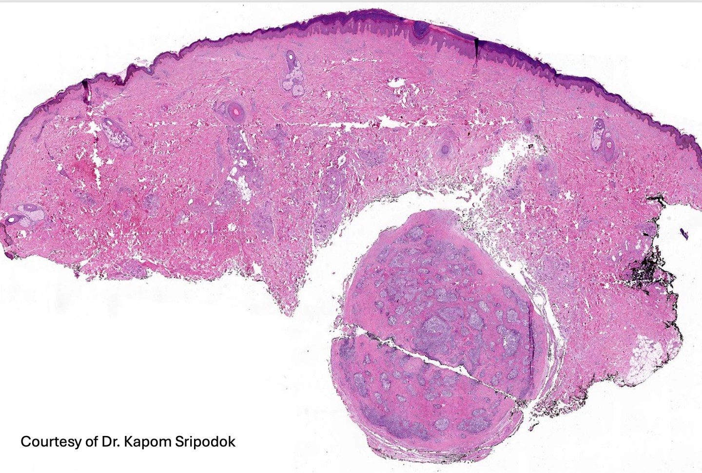 Cutaneous lymphadenoma – McKee Derm