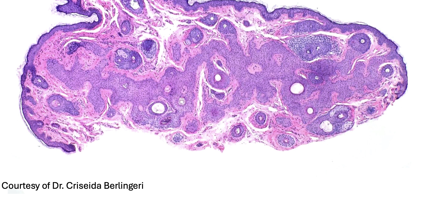 Follicular infundibulum tumor – McKee Derm