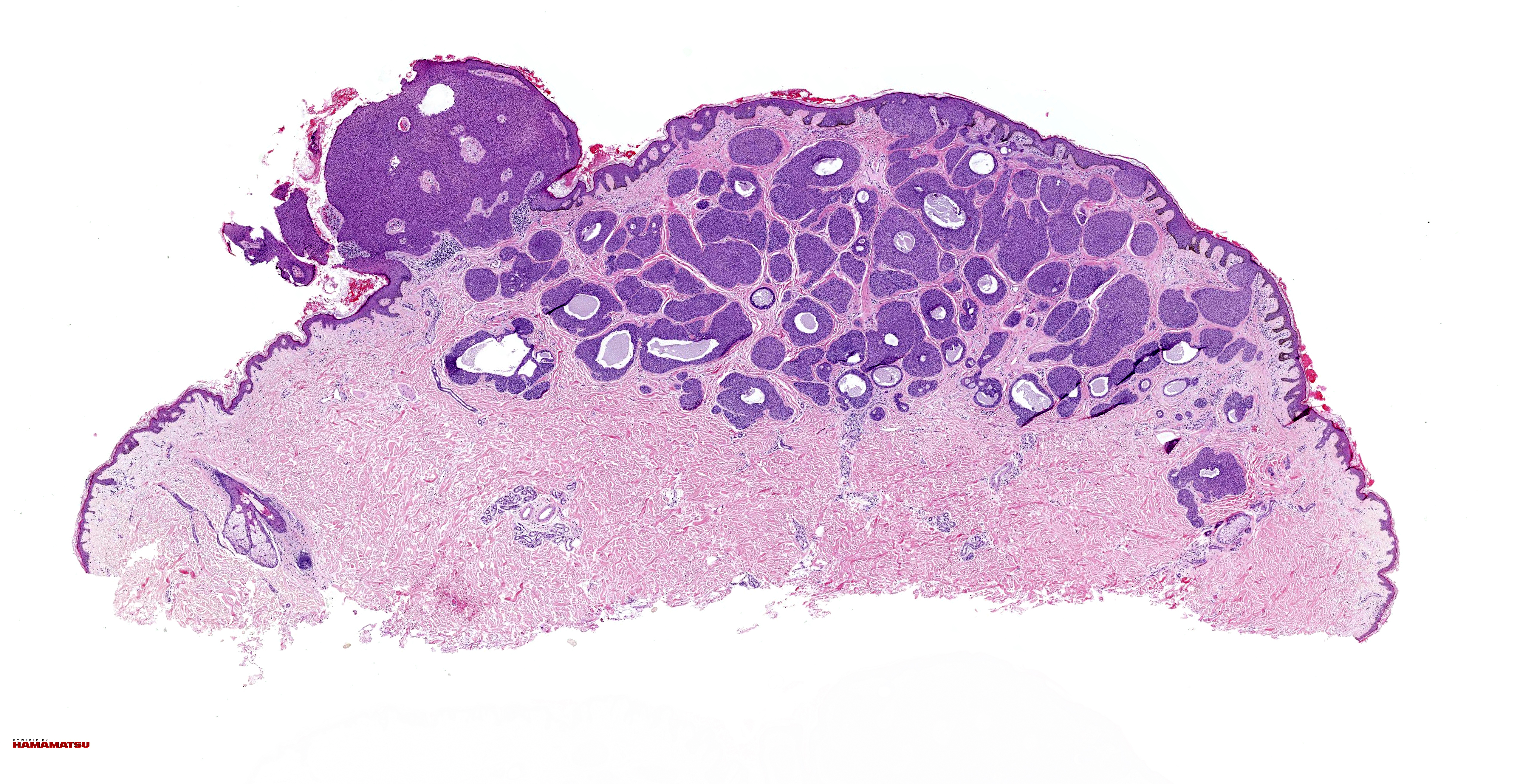 Poroma including hidroacanthoma simplex & dermal duct tumor – McKee Derm