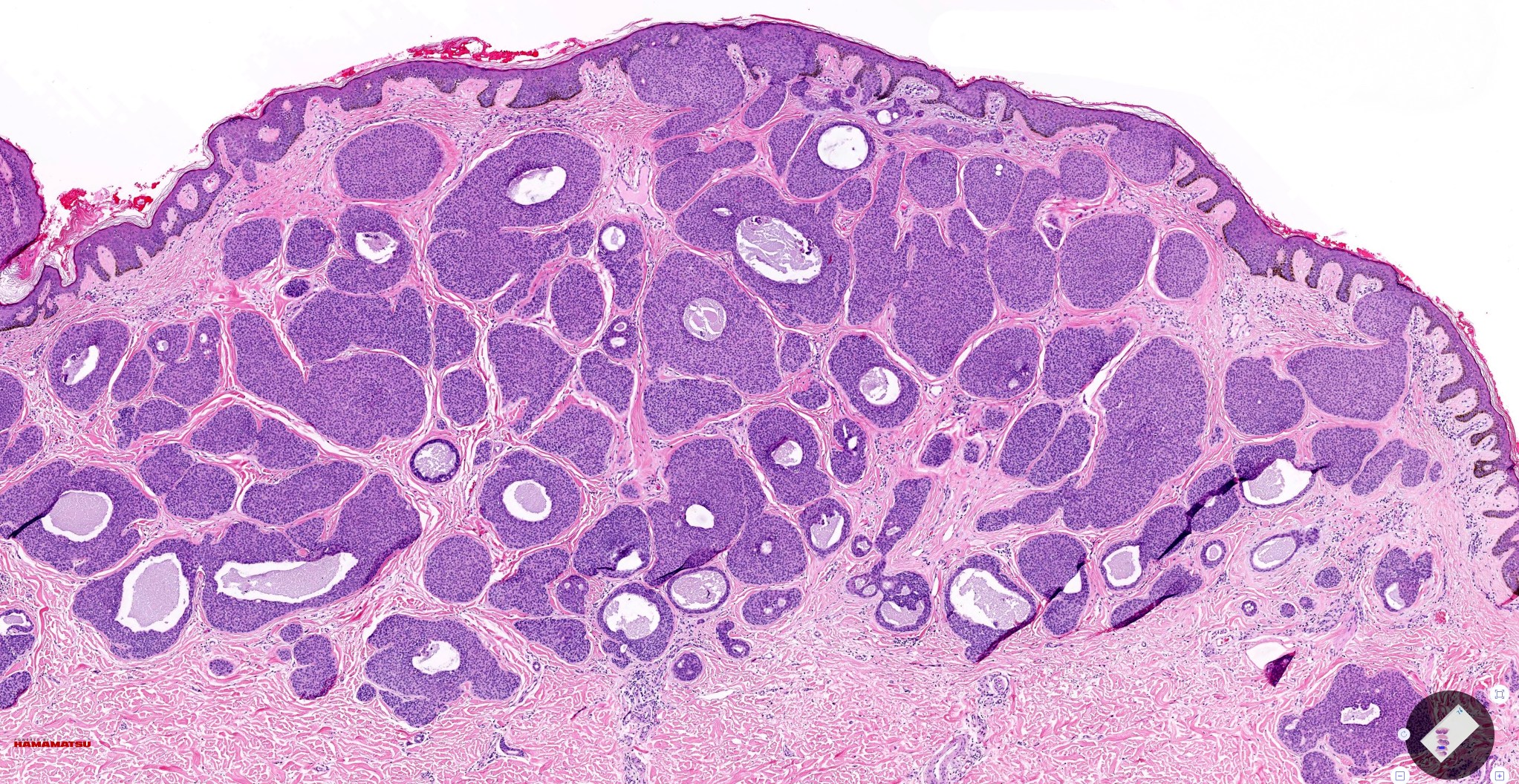 Poroma including hidroacanthoma simplex & dermal duct tumor – McKee Derm